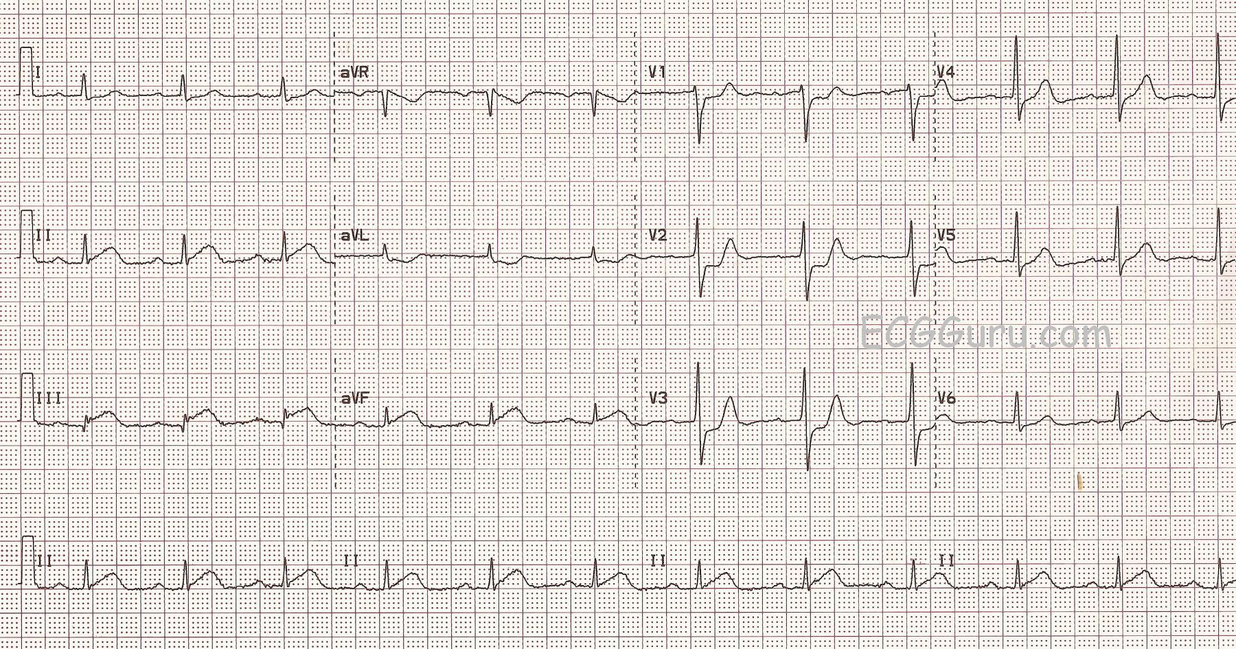 Inferior Wall M.I. With Subtle ST Elevation | ECG Guru - Instructor Resources